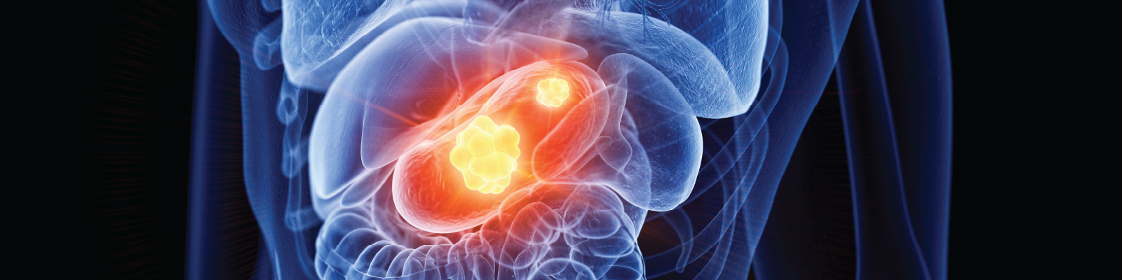 7 Signs of Stomach Cancer